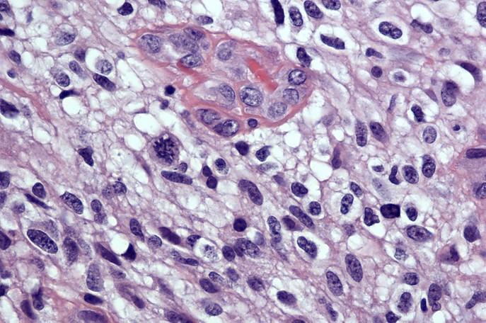 Glioblastoma IDH wildtype | MyPathologyReport