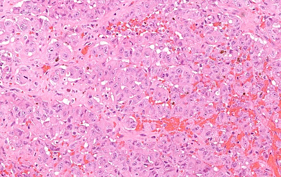 Your pathology report for angiosarcoma | MyPathologyReport