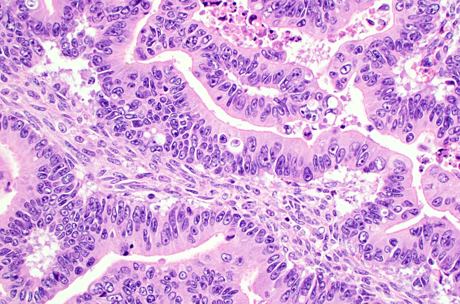 Mucinous Carcinoma ovary MyPathologyReport ca