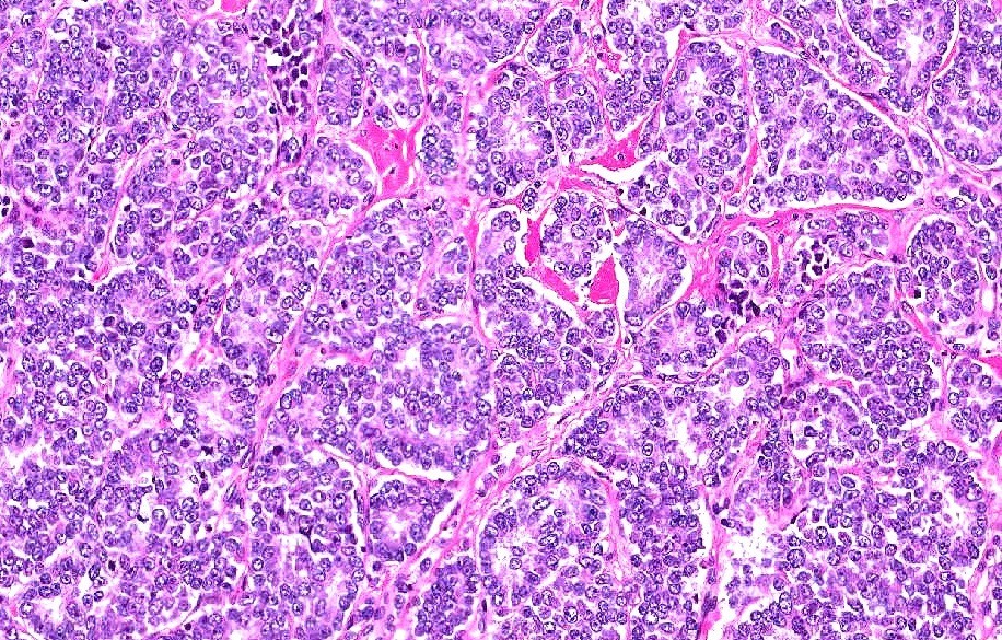 Votre rapport de pathologie pour le sarcome d'Ewing | MyPathologyReport