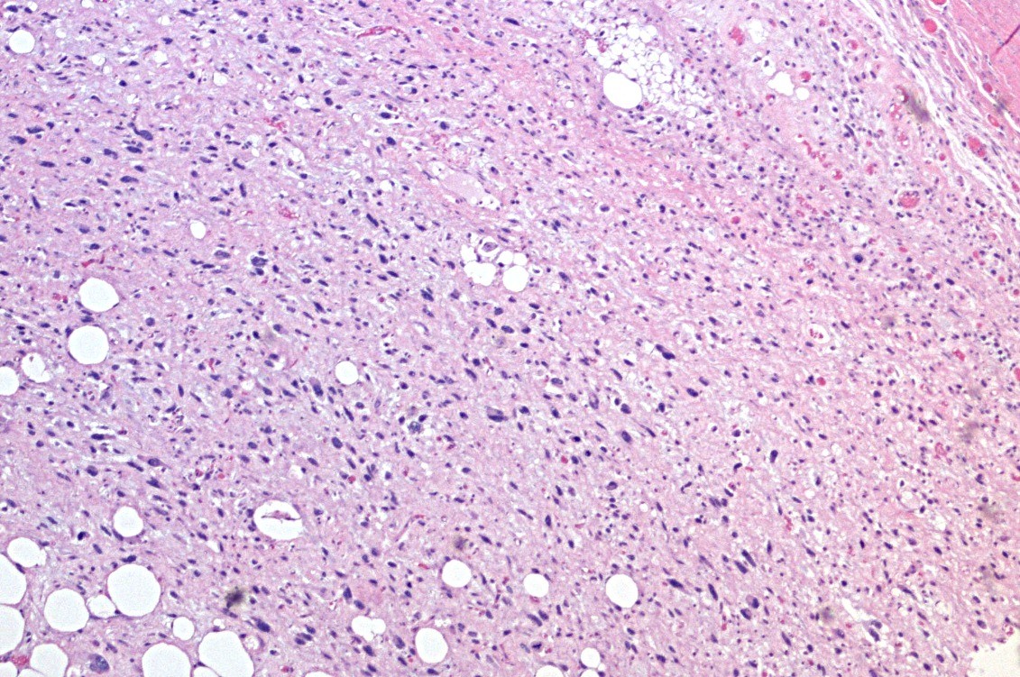 Your pathology report for dedifferentiated liposarcoma | MyPathologyReport