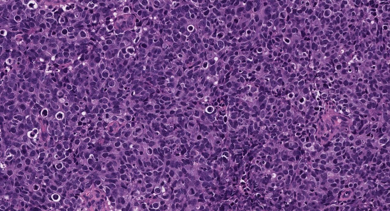 Your pathology report for sinonasal undifferentiated carcinoma (SNUC ...