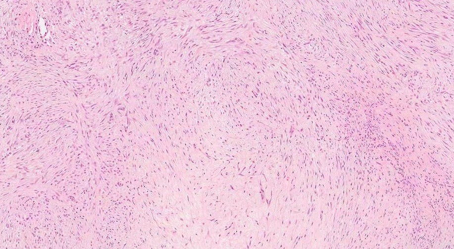 Your pathology report for nodular fasciitis | MyPathologyReport