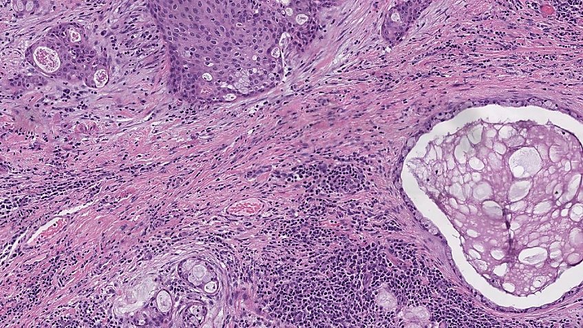 Uw pathologierapport voor muco-epidermoïde carcinoom | MyPathologyReport