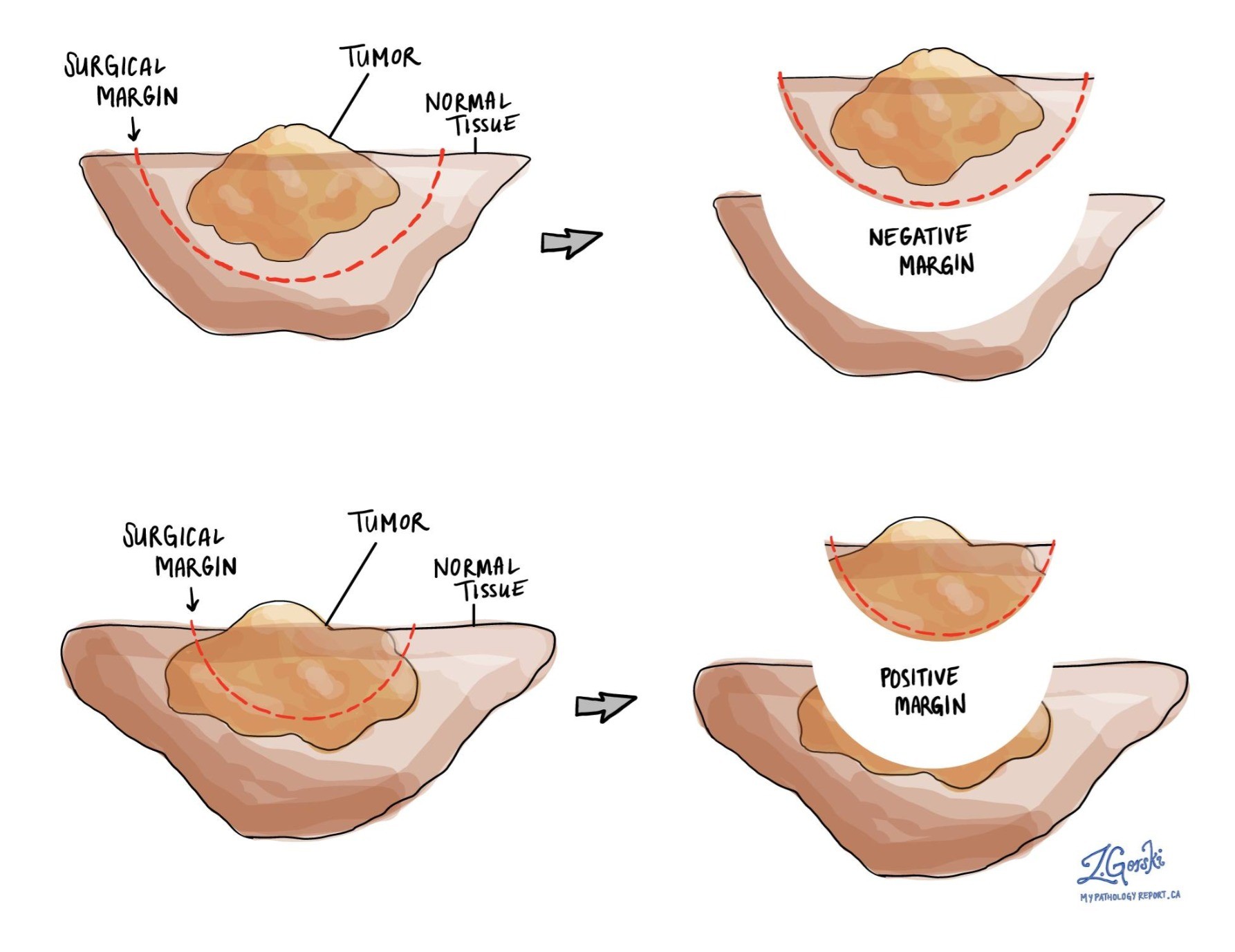 Margin MyPathologyReport ca