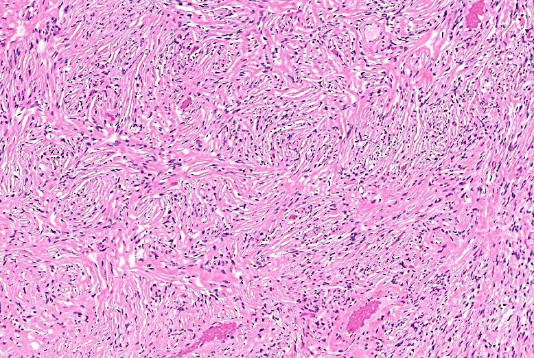 Tumore fibroso solitario | MyPathologyReport