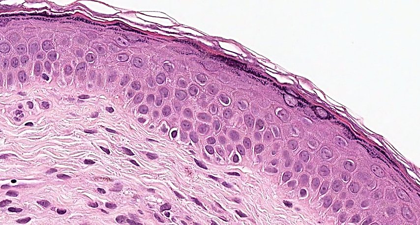 What are squamous cells? - MyPathologyReport.ca