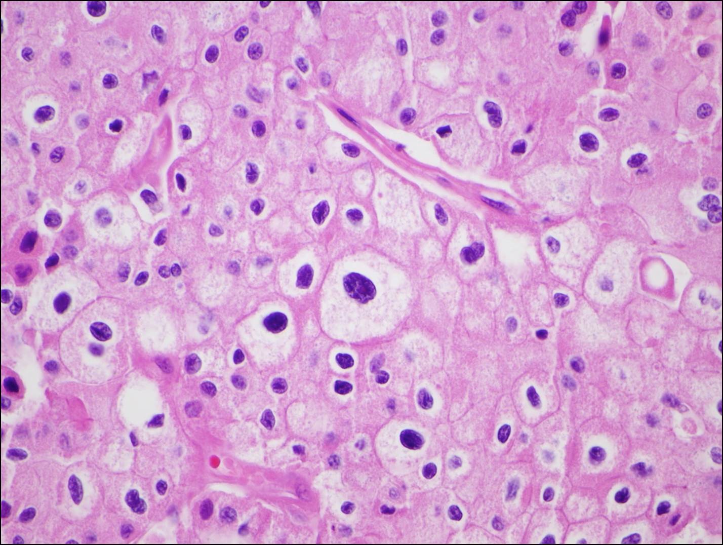 Chromophobe renal cell carcinoma - MyPathologyReport.ca