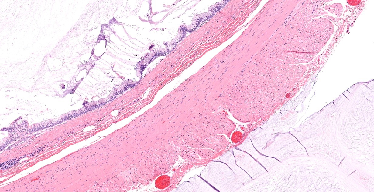 Din patologirapport för låggradig blindtarmsslemhinna i slemhinnan ...