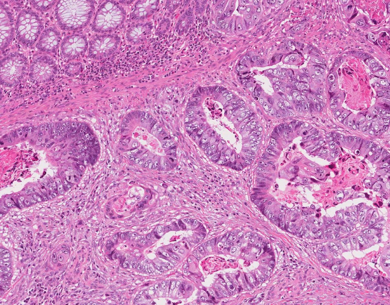 Adenocarcinoma Colon MyPathologyReport ca Adenocarcinoma Colon MyPathologyReport ca