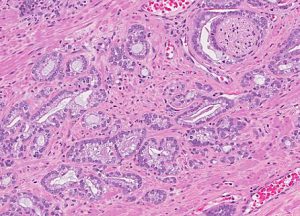 prostate-adenocarcinoma – MyPathologyReport