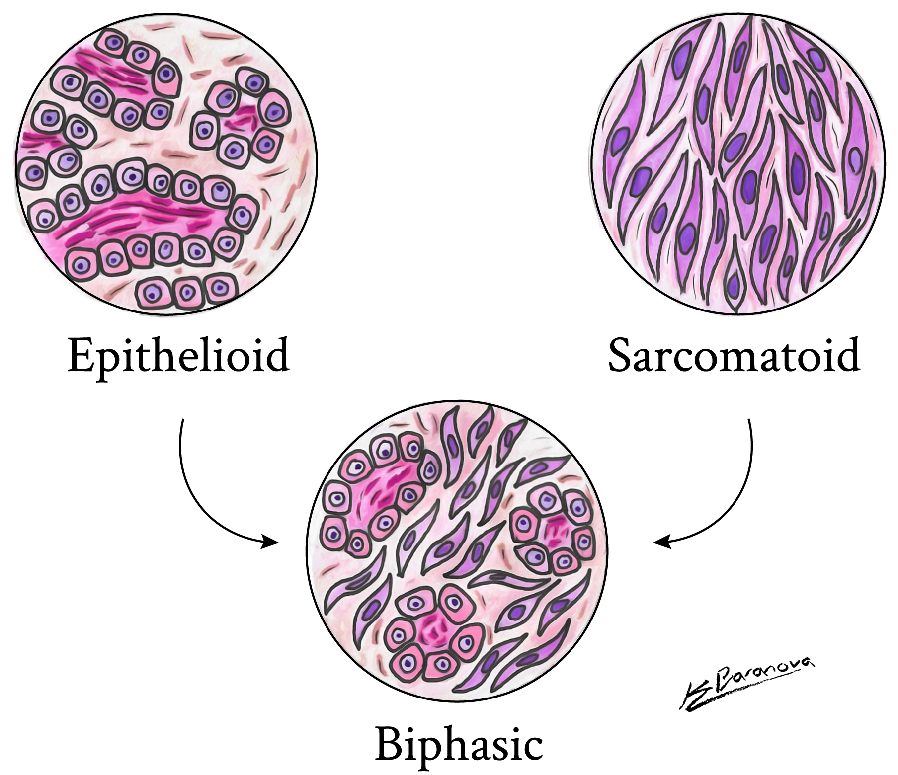 Mesothelioma MyPathologyReport ca Mesothelioma MyPathologyReport ca