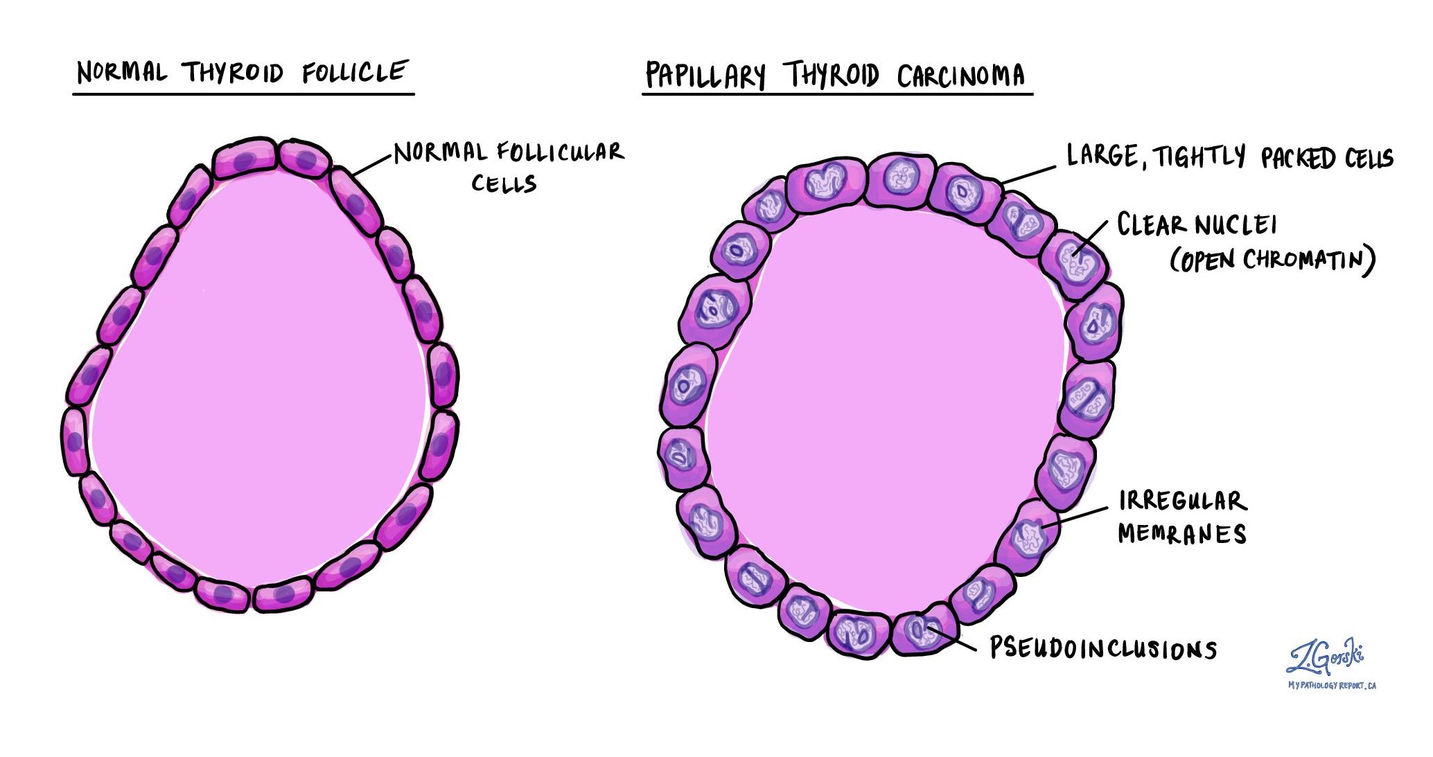Papillary Thyroid Carcinoma MyPathologyReport ca