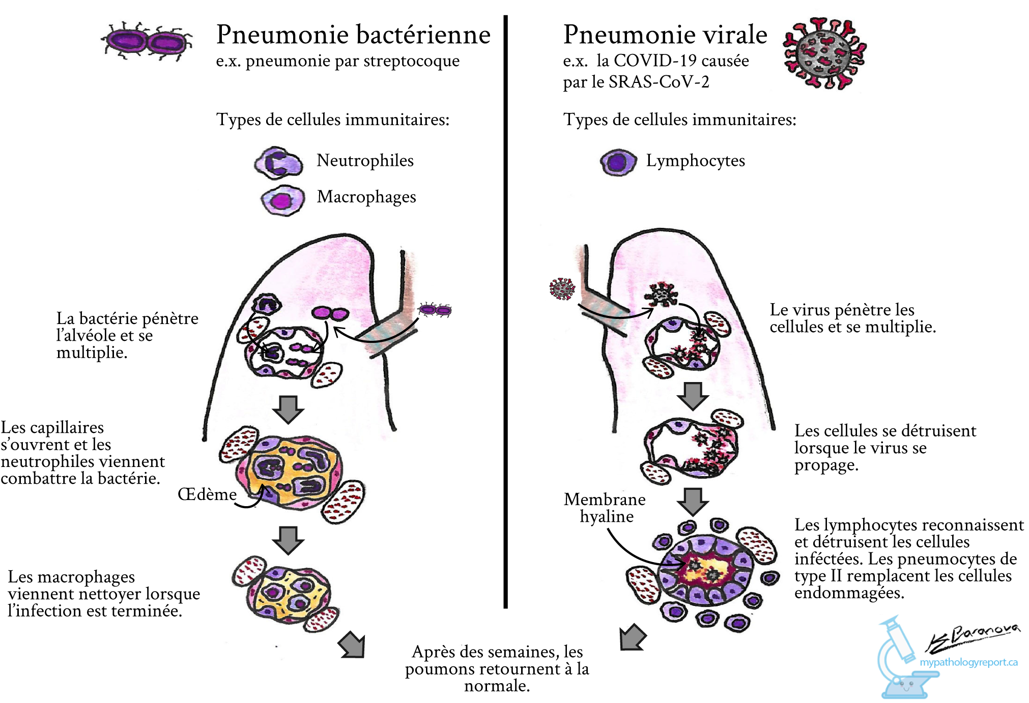 Point De Pneumonie – Pneumonie Définition Médicale – LFMY