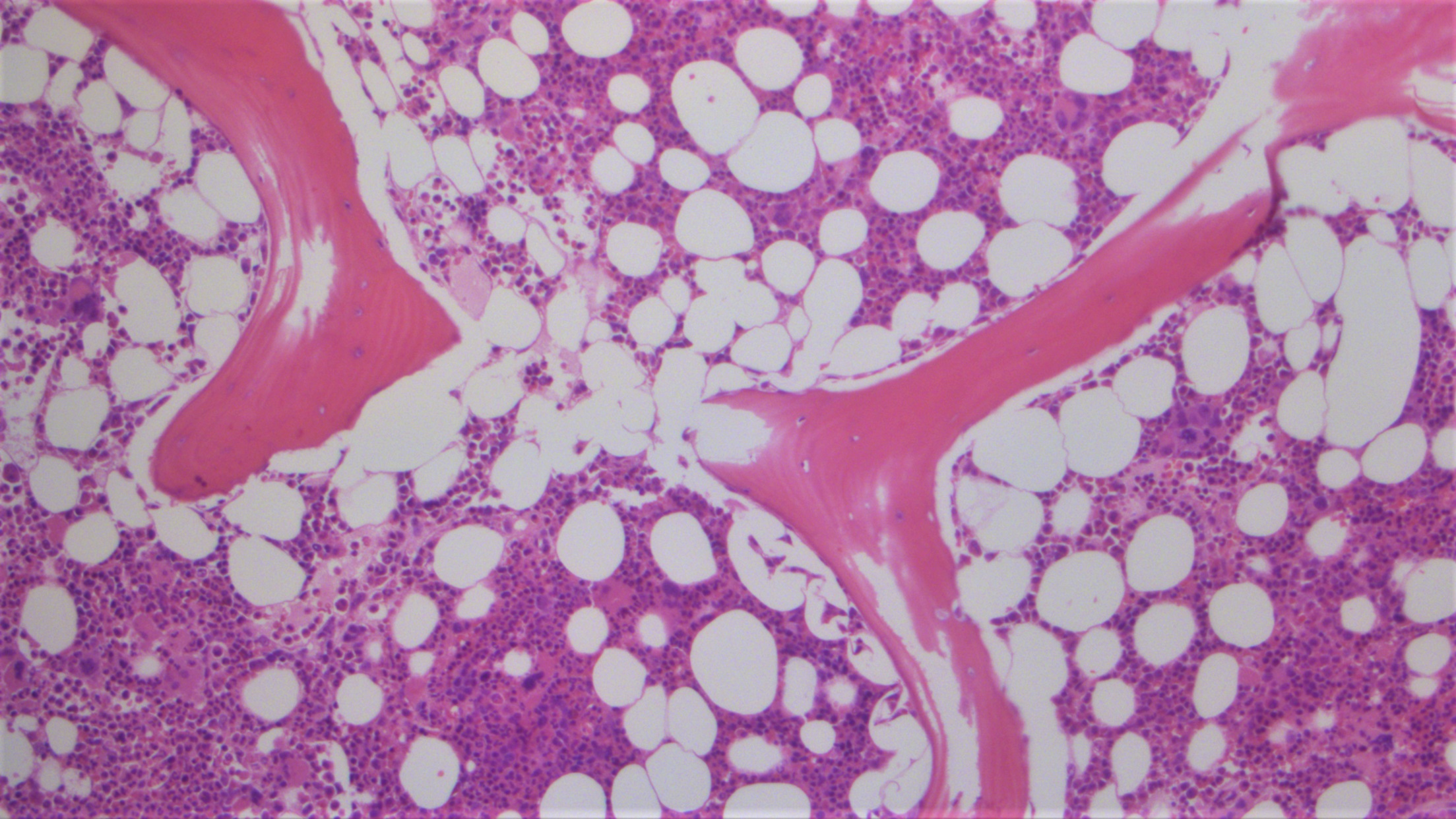 View Bone Marrow Fibrosis Histology Pics
