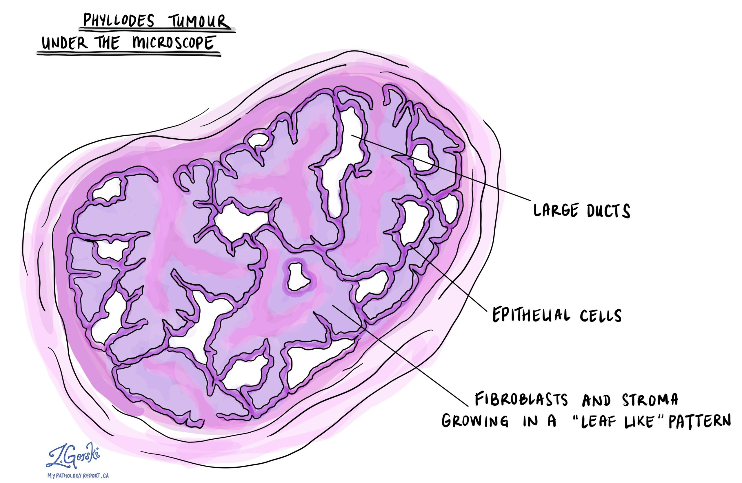 Phyllodes Tumour breast MyPathologyReport ca Phyllodes Tumour breast MyPathologyReport ca