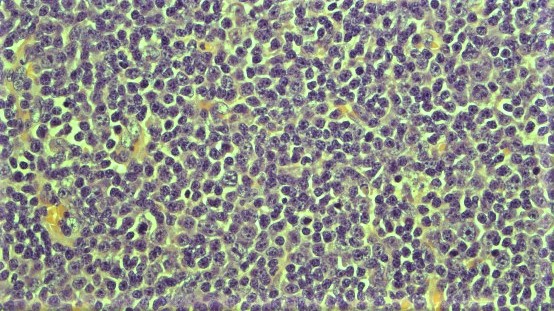 Your pathology report for chronic lymphocytic leukemia (CLL ...