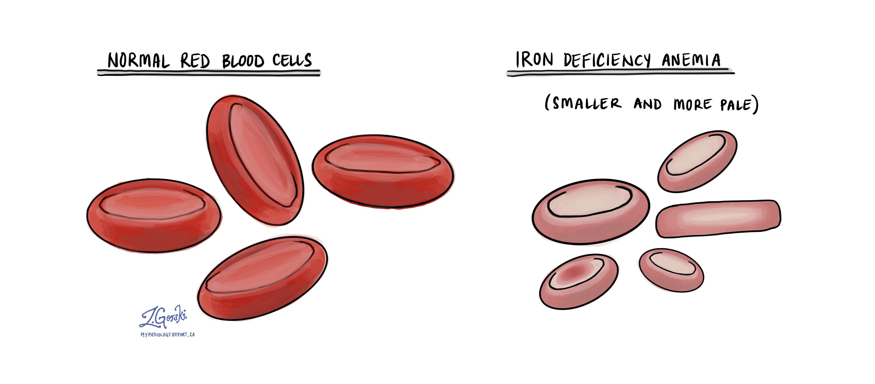 Iron Deficiency Anemia MyPathologyReport ca