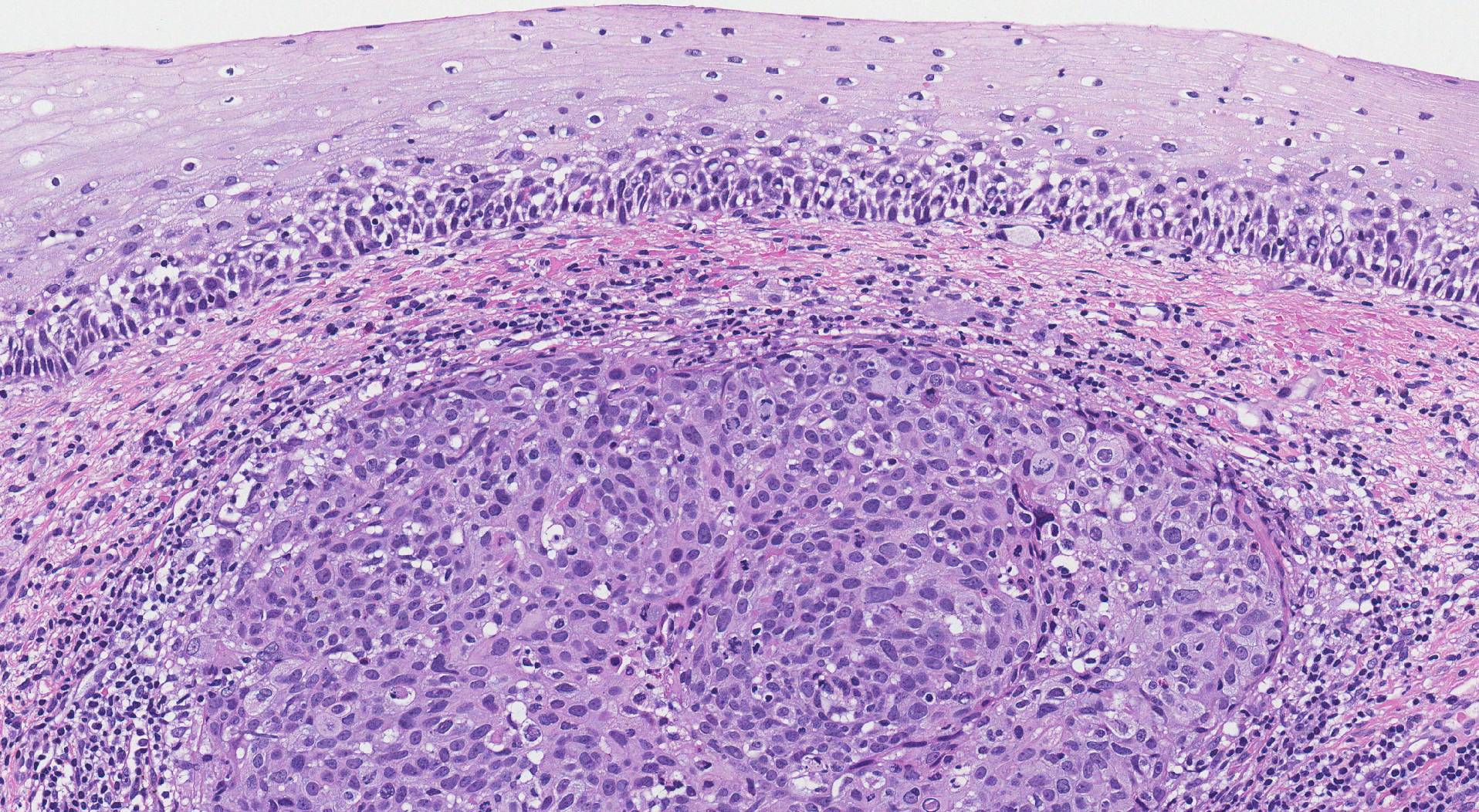 Squamous Cell Carcinoma Of The Cervix MyPathologyReport ca