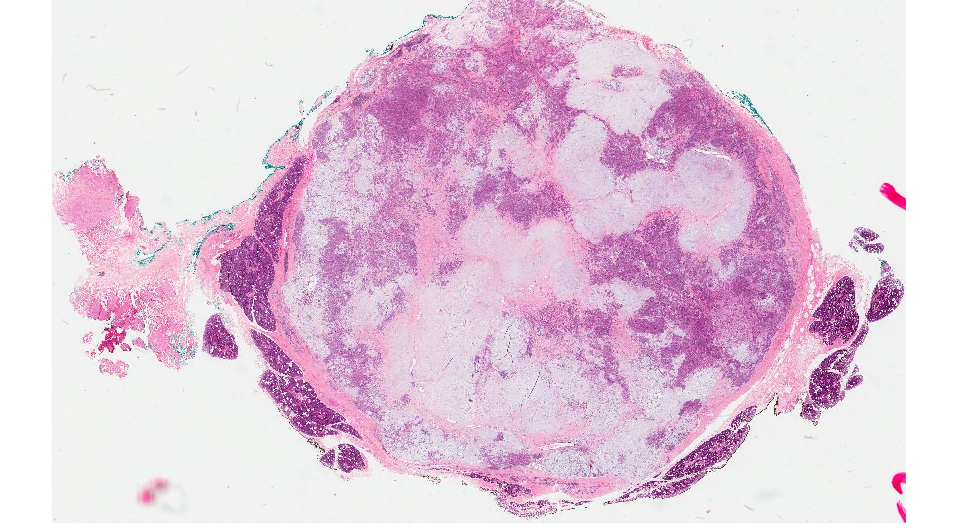 Pleomorphic Adenoma Pathology