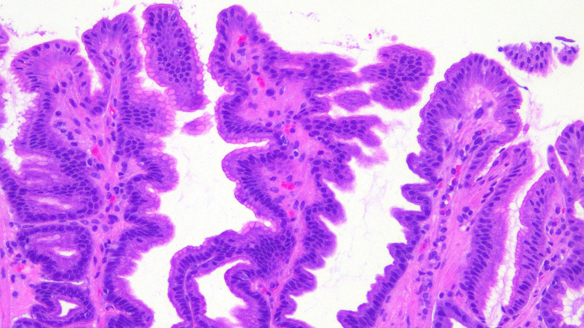 Reactive gastropathy | MyPathologyReport