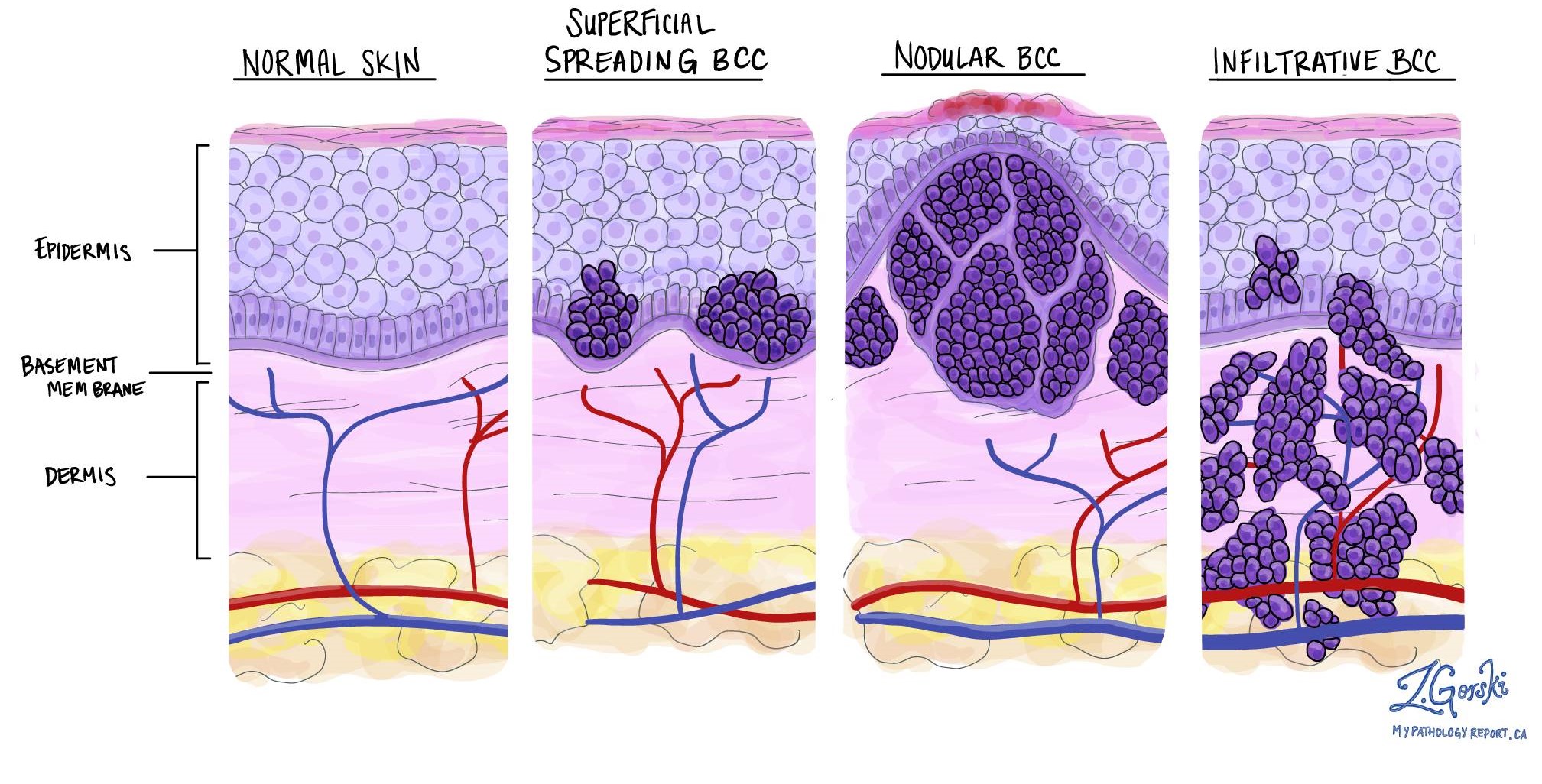 Basal Cell Carcinoma Of The Skin MyPathologyReport ca