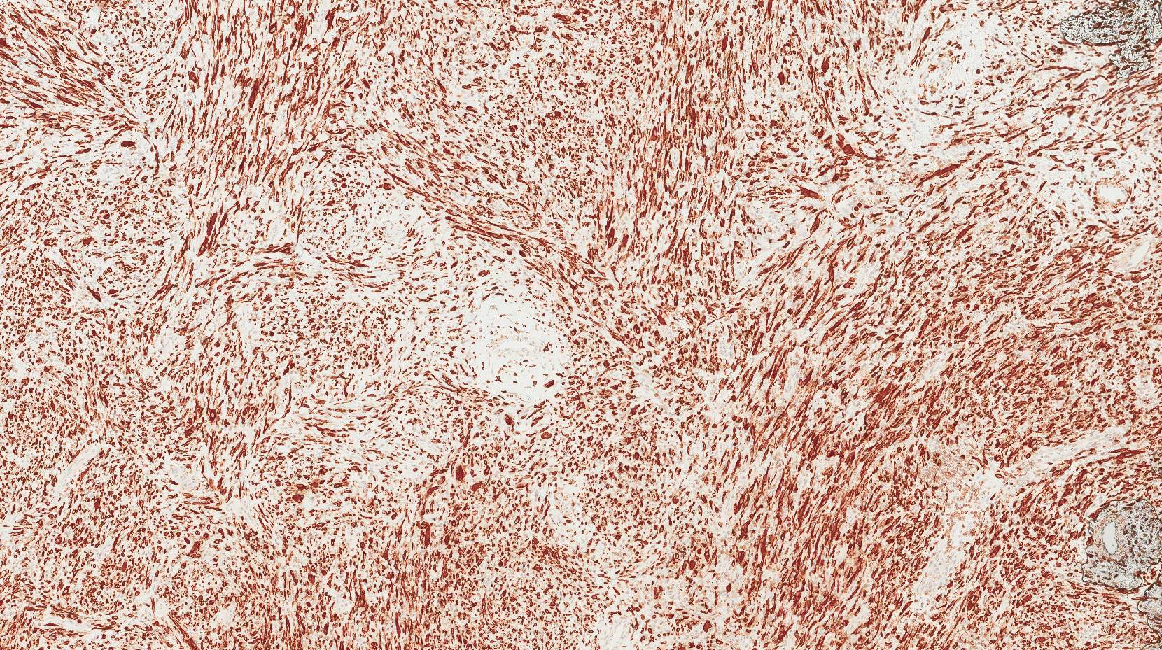 IHC | Pathology dictionary | MyPathologyReport.ca