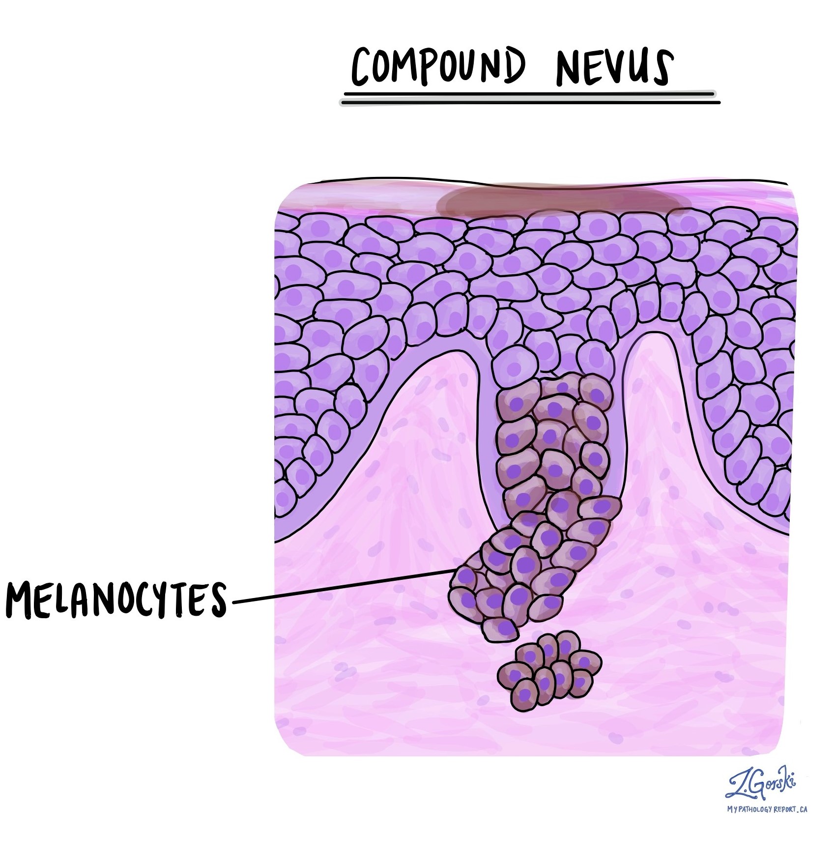 Congenital Melanocytic Nevus Compound Type