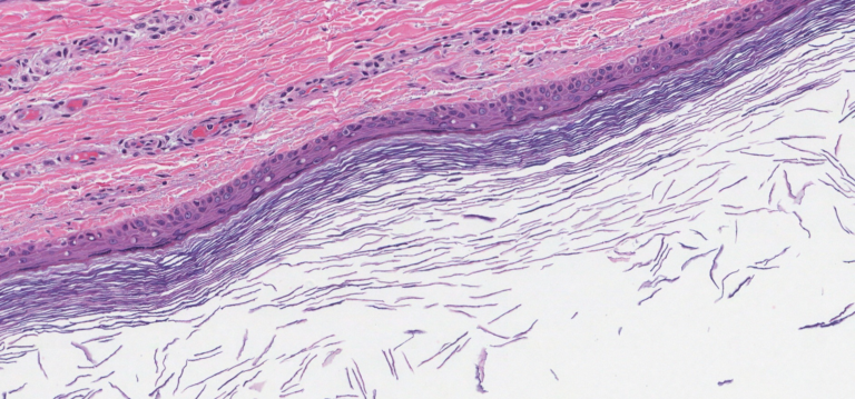 Epidermoid cyst | MyPathologyReport.ca