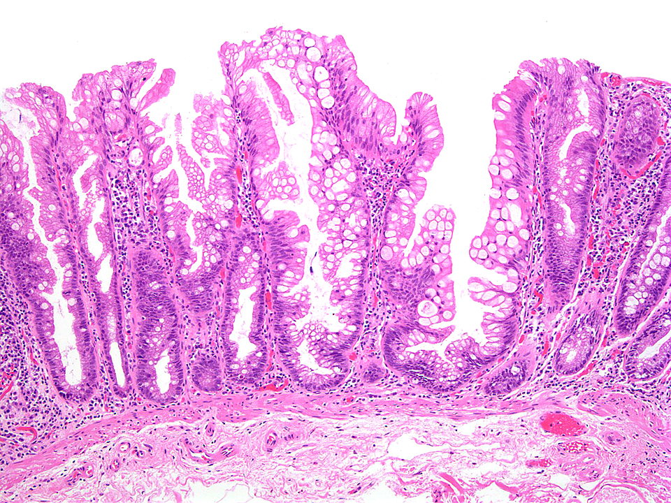 Sessile Serrated Polyp Of The Colon And Rectum MyPathologyReport ca