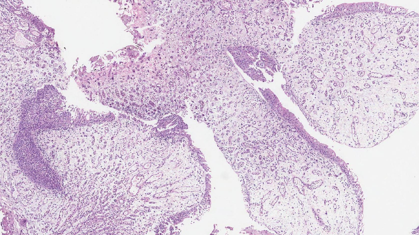 Polypoid cystitis | MyPathologyReport