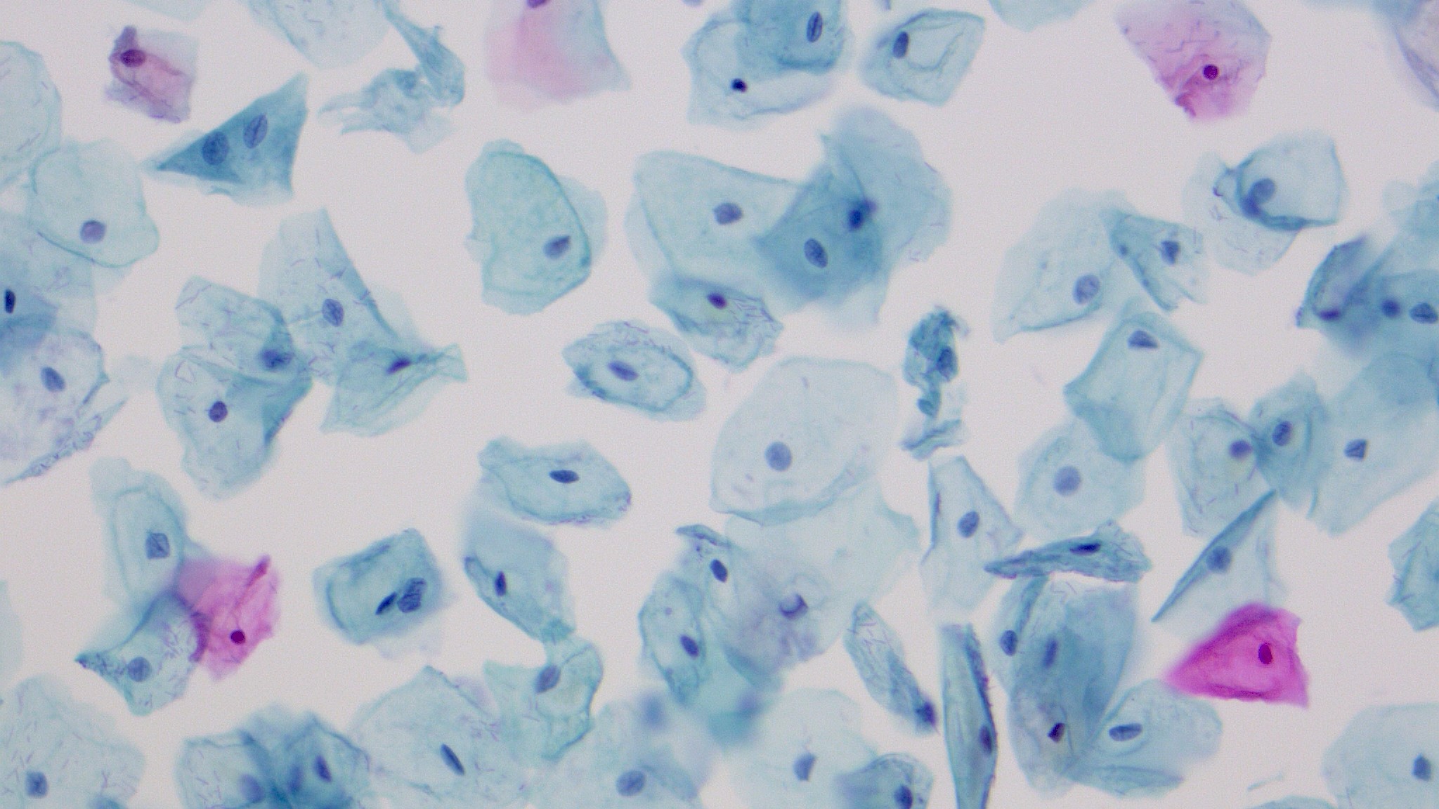 Negative For Intraepithelial Lesion Or Malignancy NILM