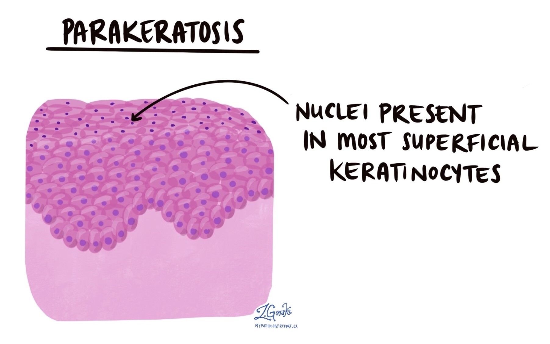 Qu'est-ce que la parakératose ? | MyPathologyReport