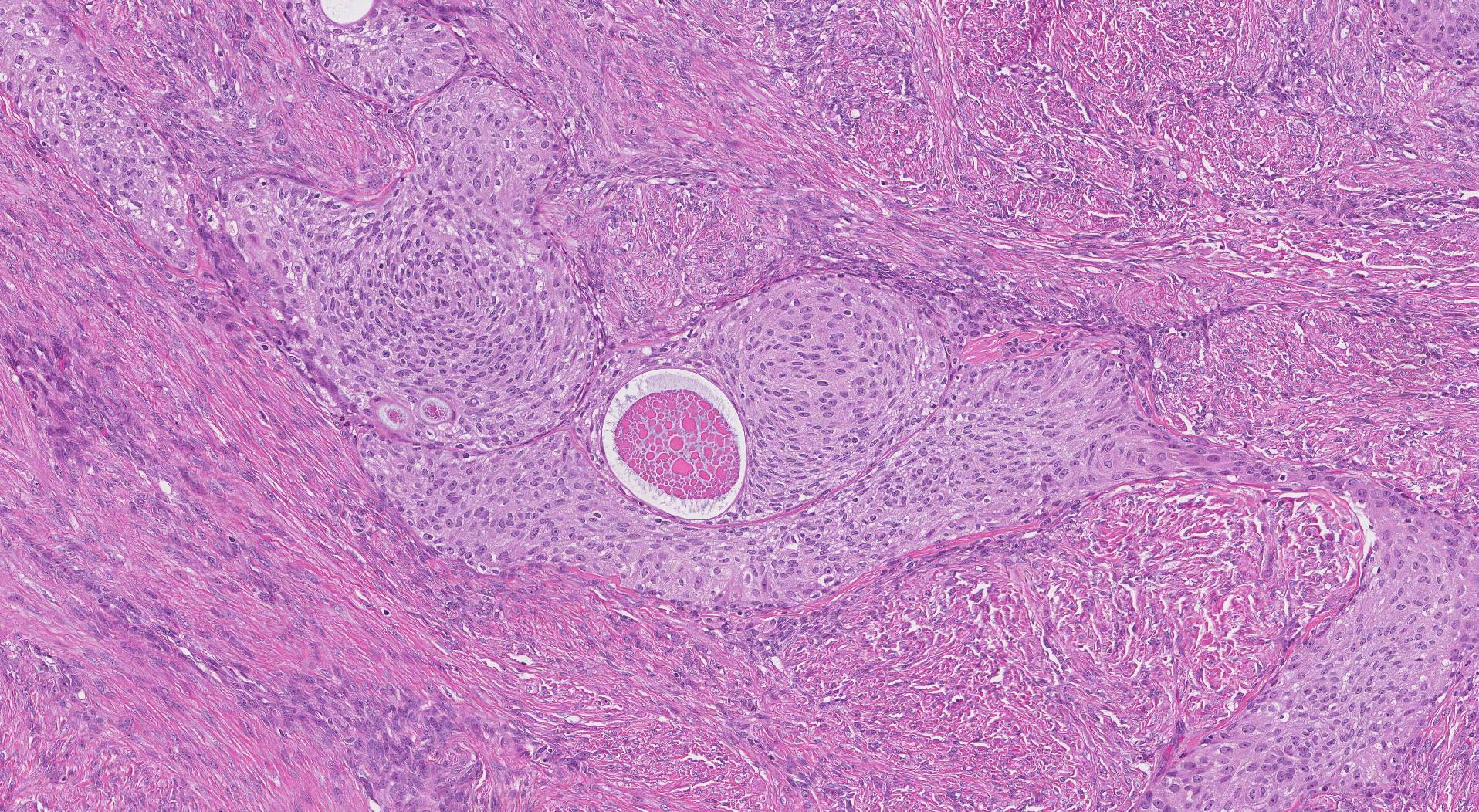 Votre rapport de pathologie pour une tumeur bénigne de Brenner ...