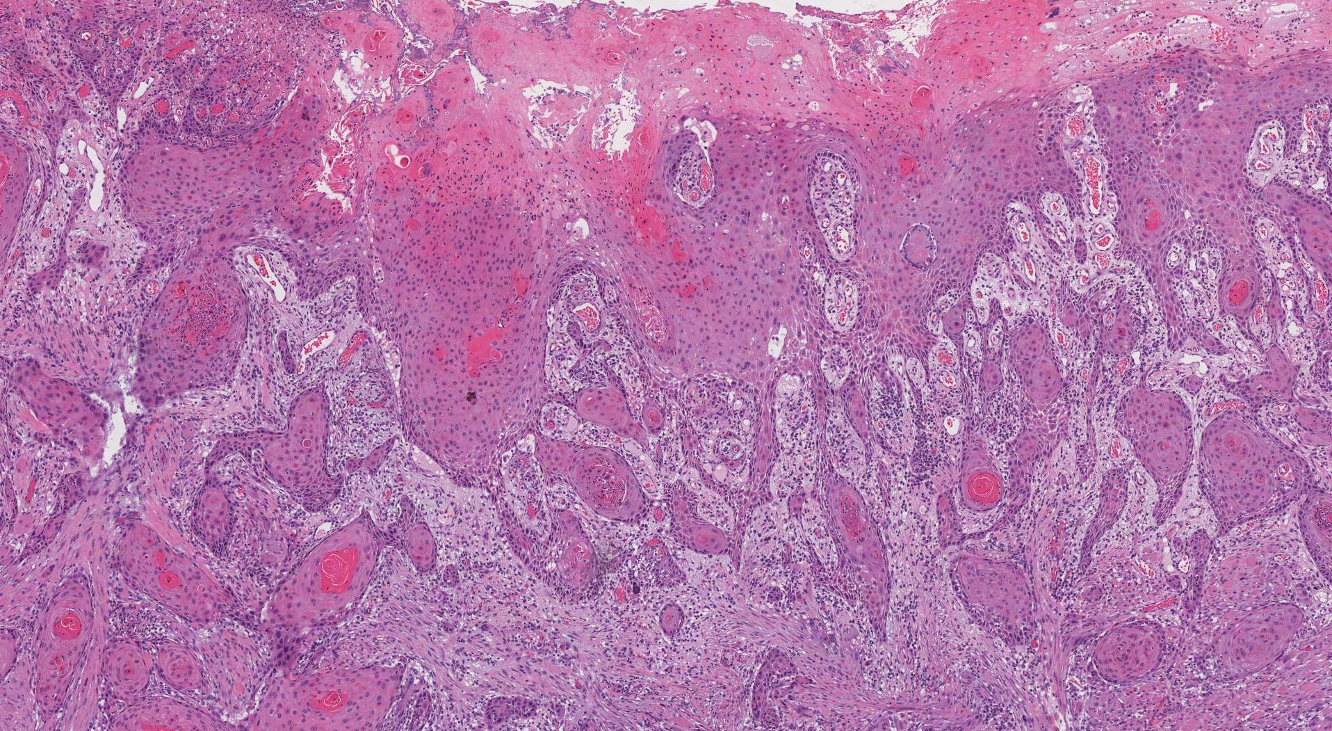 Squamous Cell Carcinoma Of The Oral Cavity MyPathologyReport ca