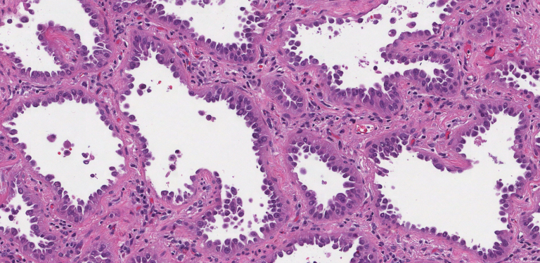 Adenocarcinoma in situ of the lung - MyPathologyReport.ca