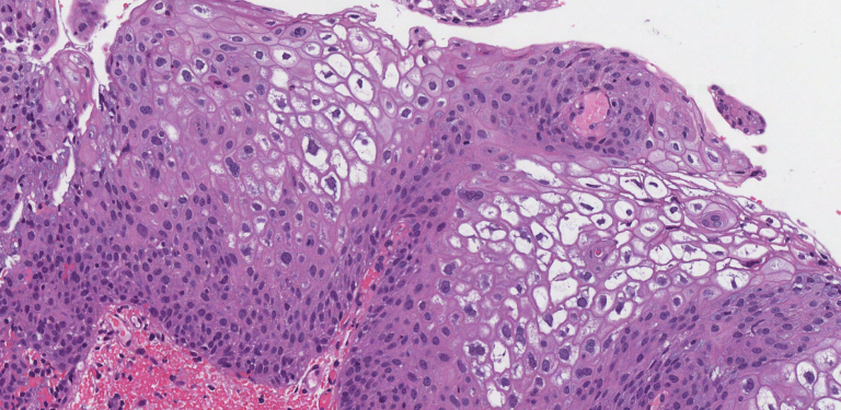 Koilozyten | MyPathologyReport.ca