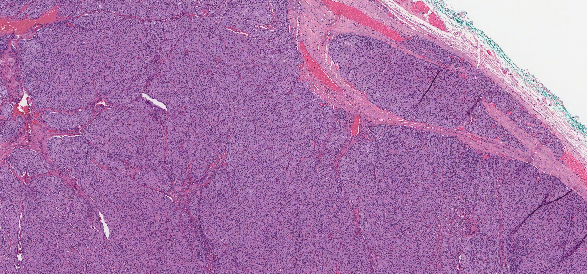 Carcinoma Folicular Da Tireoide Glândula Tiroide Humana Imagem De
