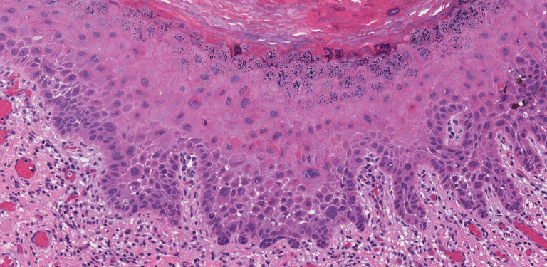 Oral epithelial dysplasia | MyPathologyReport.ca