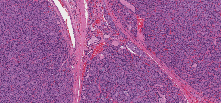 Widely invasive follicular thyroid carcinoma - MyPathologyReport.ca