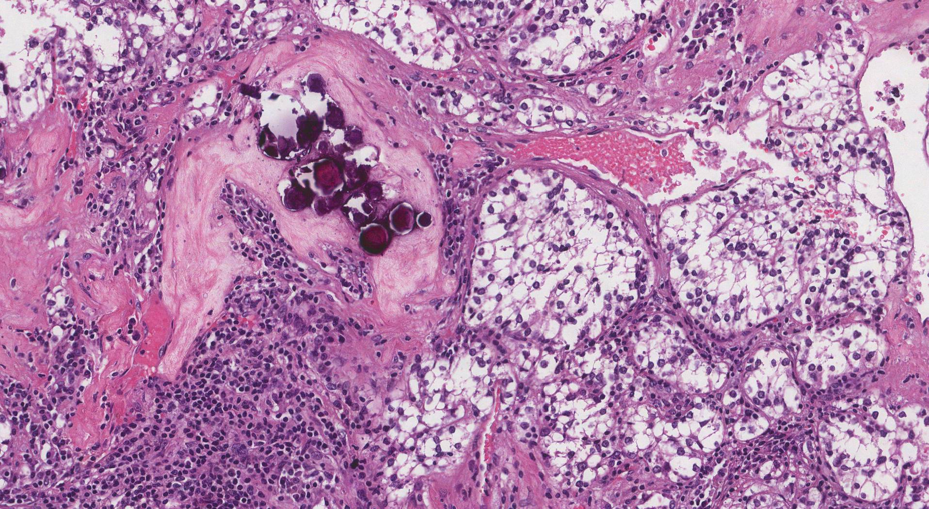 Tlaleho ea hau ea pathology bakeng sa TFE3-rearranged renal cell ...