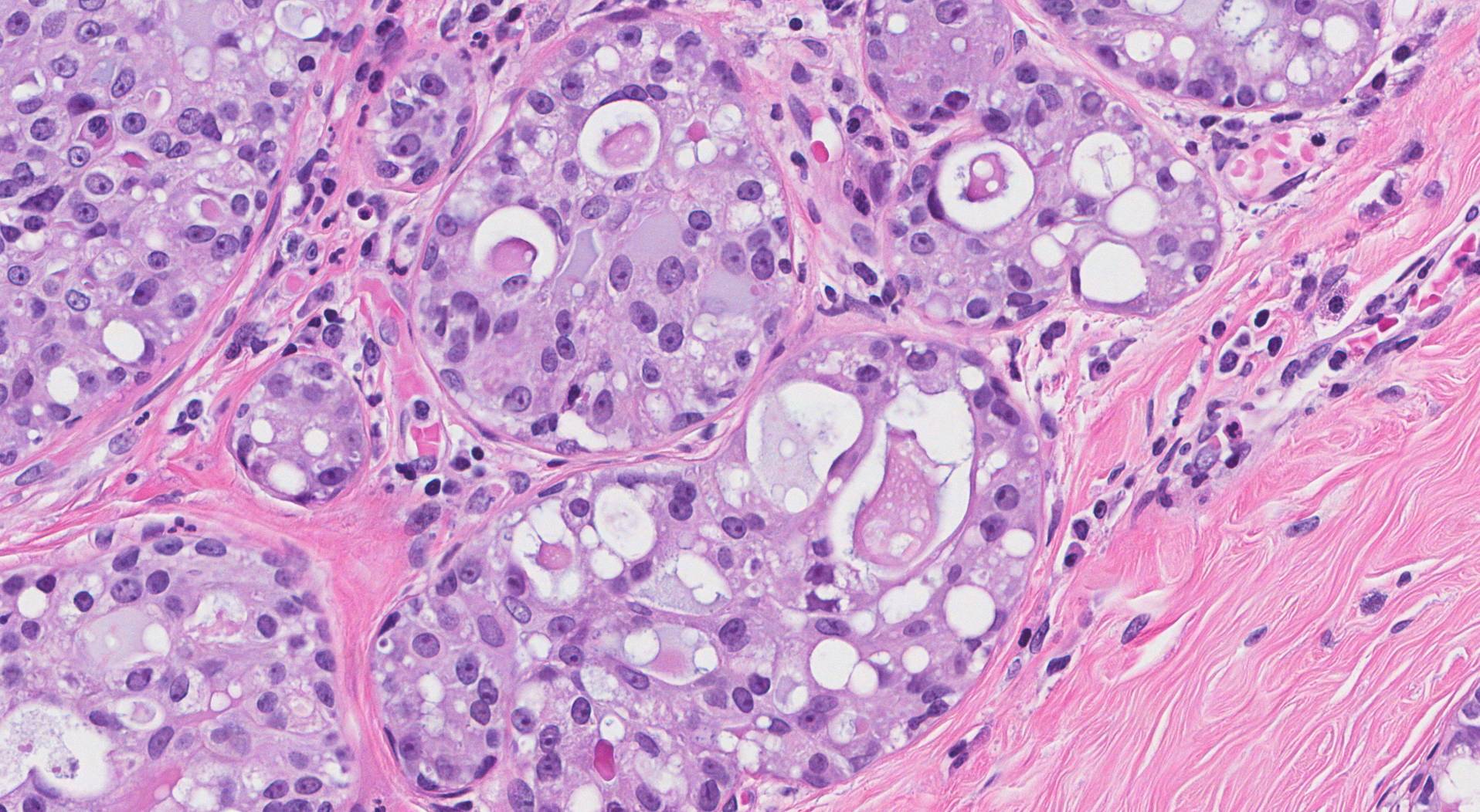 Carcinoma secretor de mama - MyPathologyReport.ca