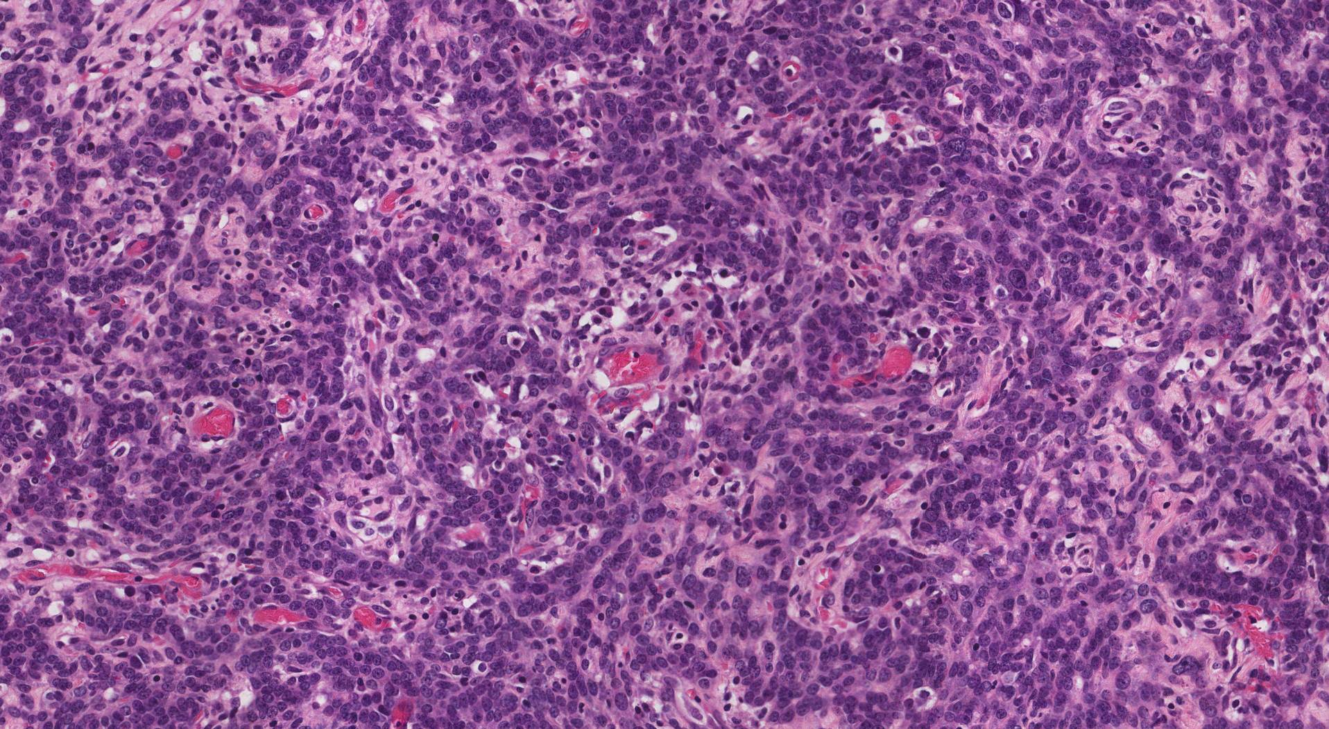 Vaša Patologická Správa O Tumore Pohlavných šnúr A Strómy Mypathologyreport