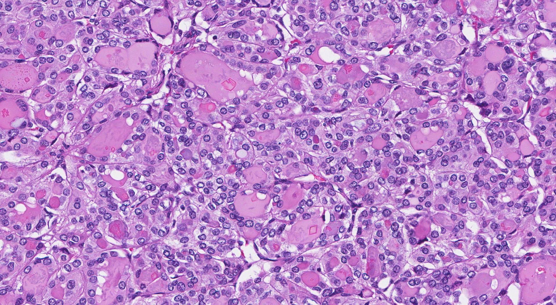 Your pathology report for infiltrative follicular variant papillary ...