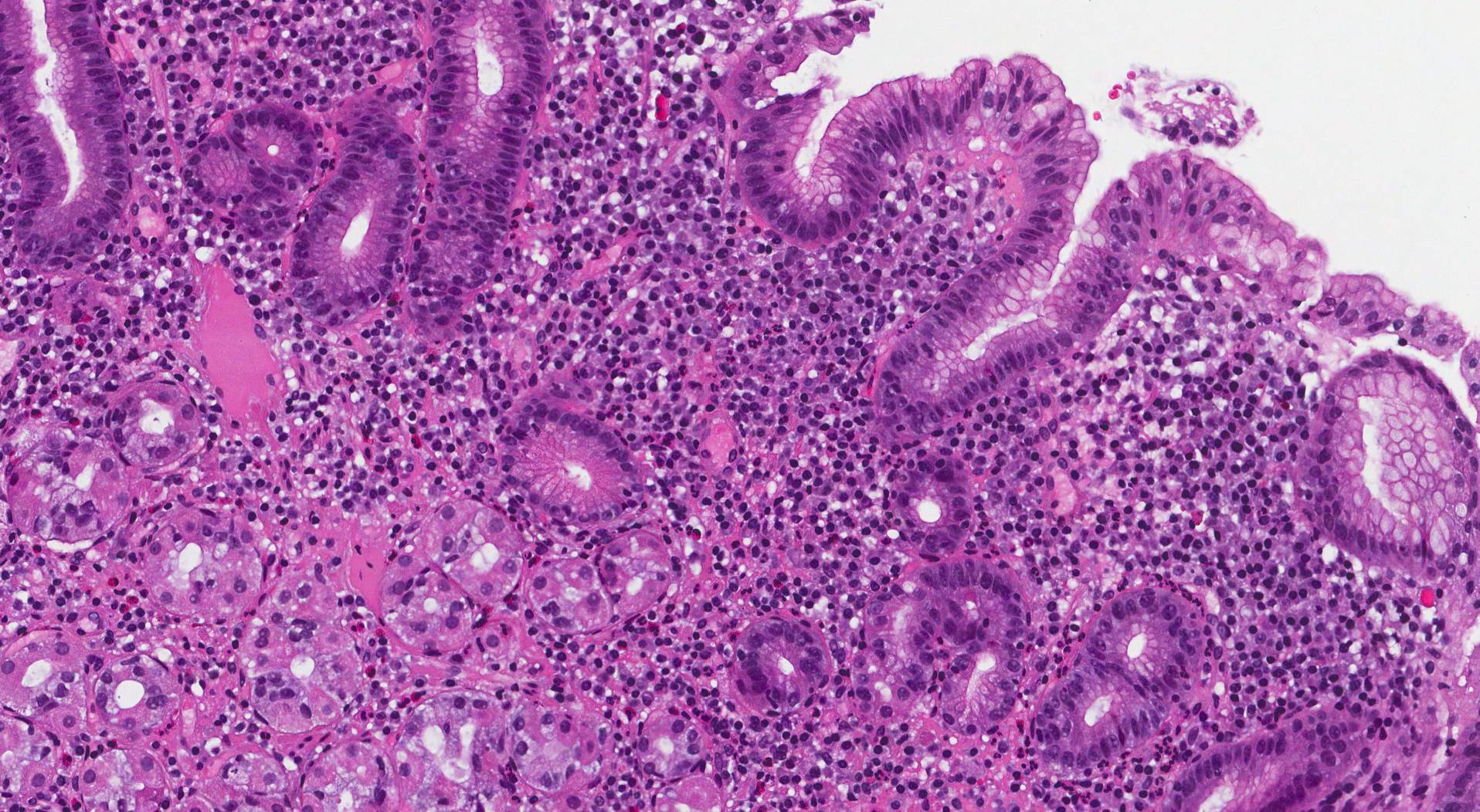 Inflammation | MyPathologyReport