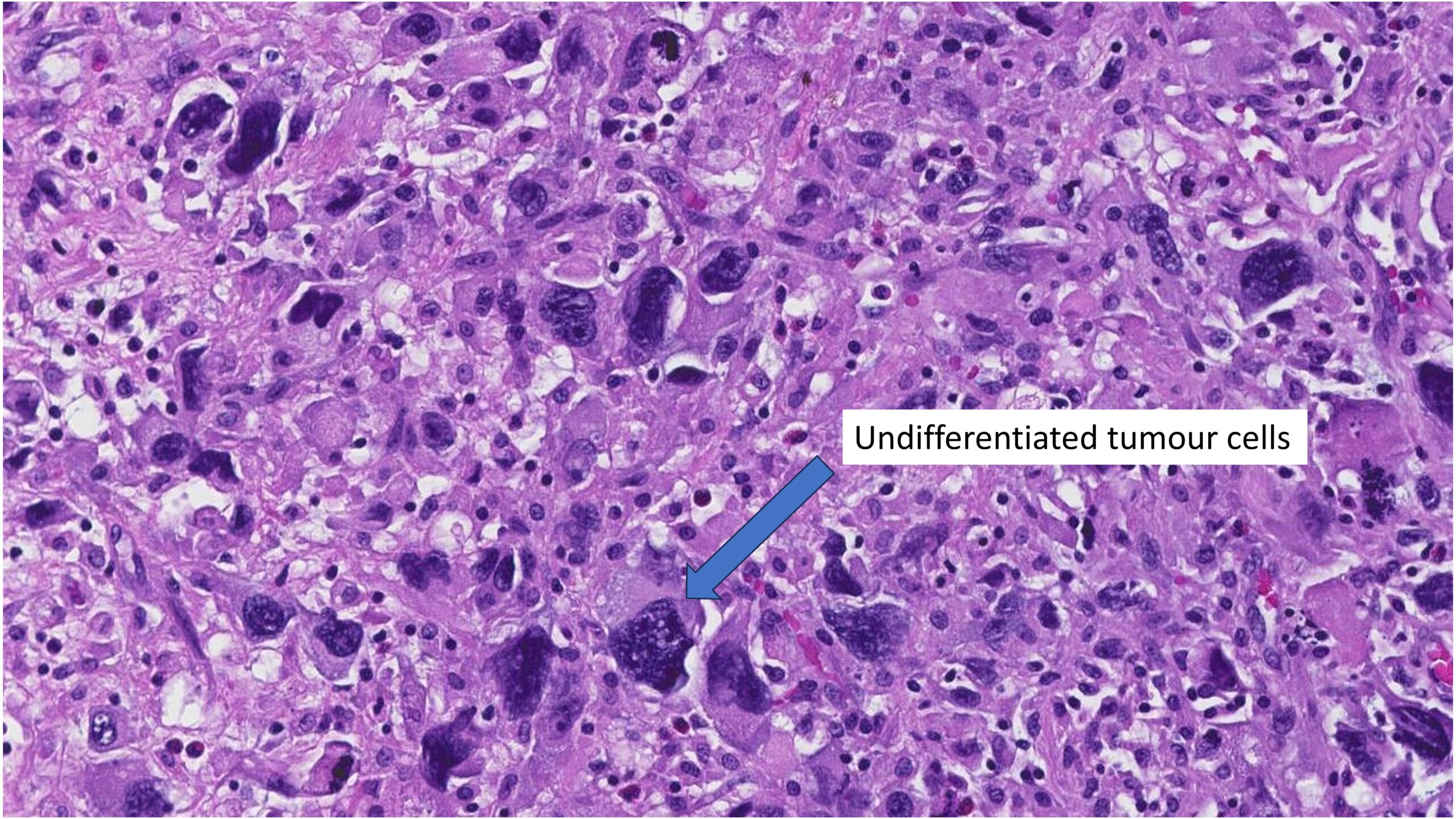 Undifferentiated MyPathologyReport ca