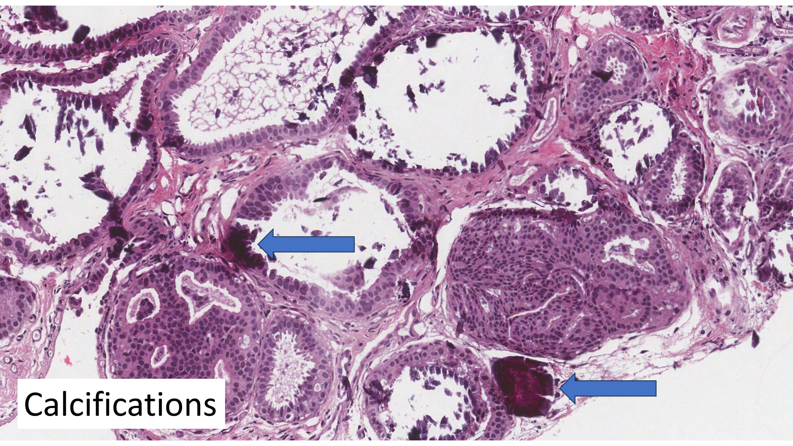 Calcification | MyPathologyReport