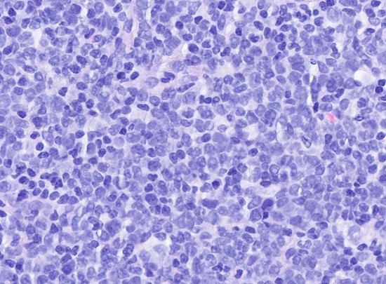 Your pathology report for B-lymphoblastic lymphoma (B-LBL ...