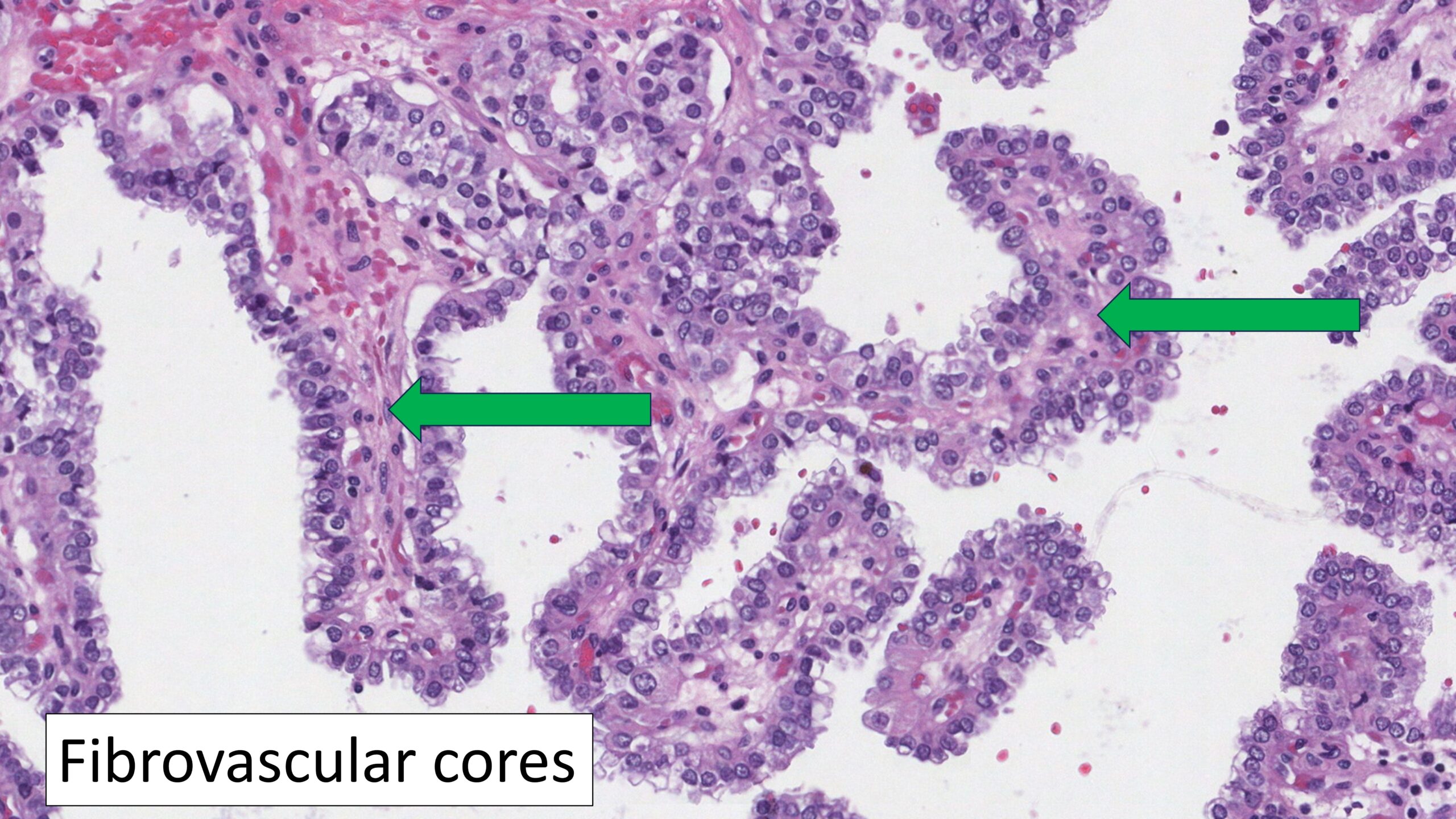 Fibrovascular core | MyPathologyReport