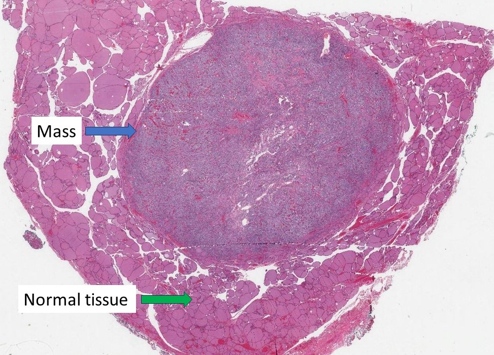 Mass MyPathologyReport ca